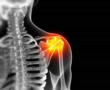 An Inside Look at a Frozen Shoulder | Advance ER | Dallas, TX